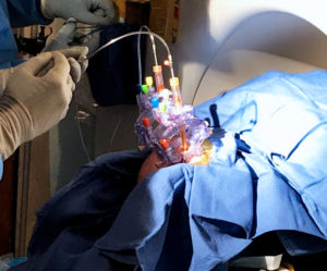 SmartFlow® Cannula - ClearPoint Neuro