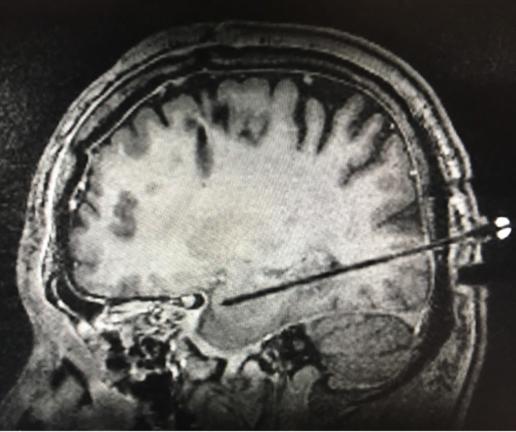 Catheter Placement - ClearPoint Neuro