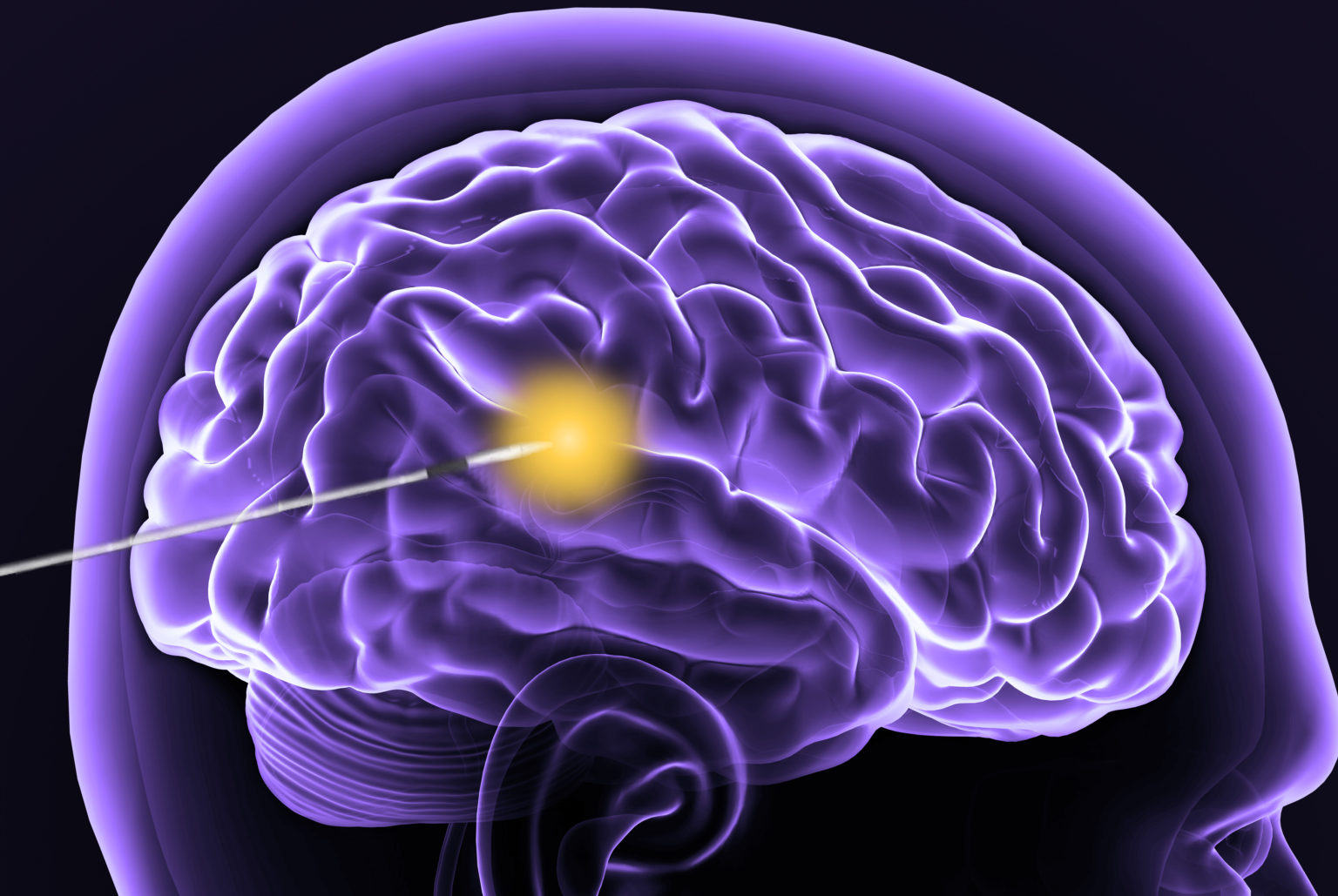 Catheter Placement - ClearPoint Neuro