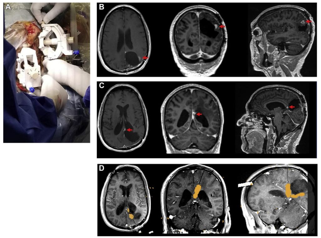 SmartFrame Array Neuro Navigation System - ClearPoint Neuro