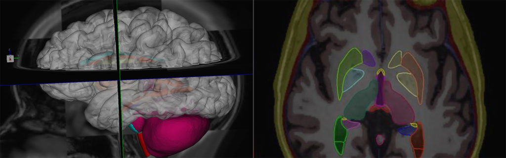 ClearPoint Maestro Brain Model - ClearPoint Neuro