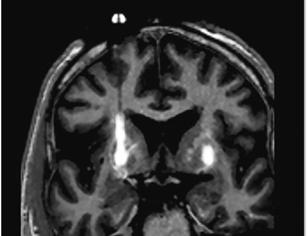 Intraparenchymal Delivery - ClearPoint Neuro